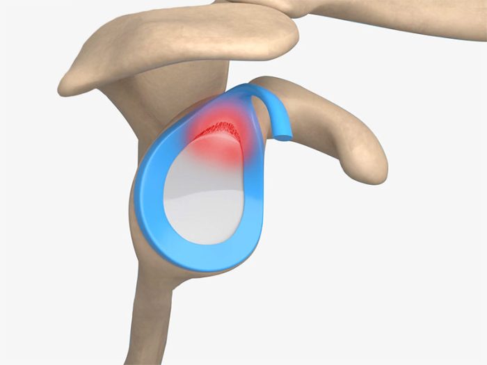 Stabilisation de type « Slap » | Institut de chirurgie spécialisée de ...