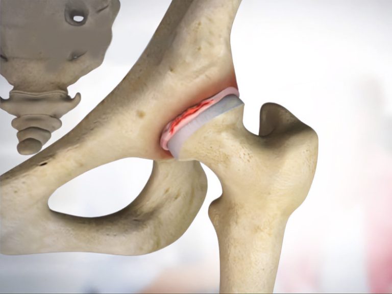 Réparation de labrum | Institut de chirurgie spécialisée de Montréal