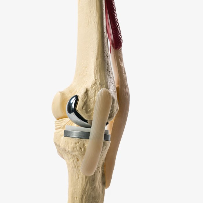 Prothèse de genou à Montréal | Chirurgien orthopédique